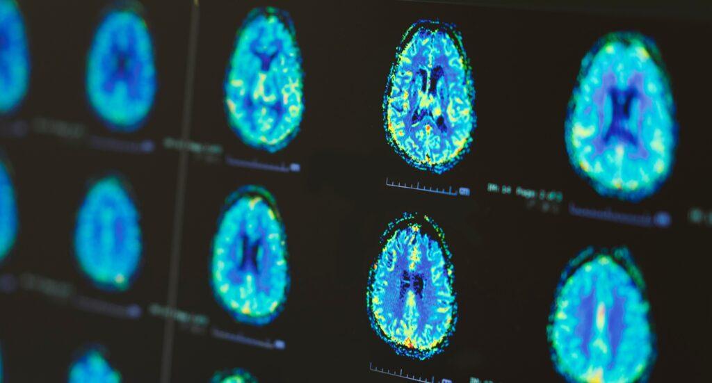 AI Tools Offer Improved Diagnosis via Brain Images | PSC